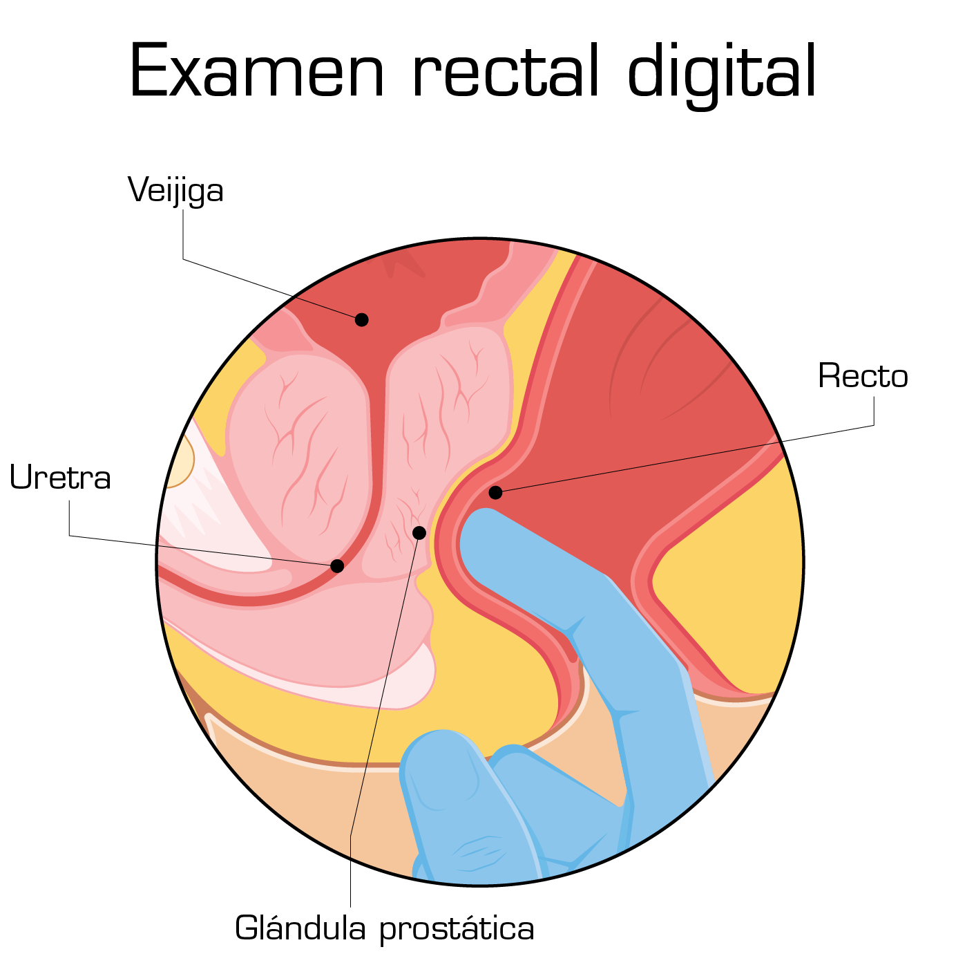 Cirugía De Hiperplasia Prostática Benigna Hpb Ems Urology